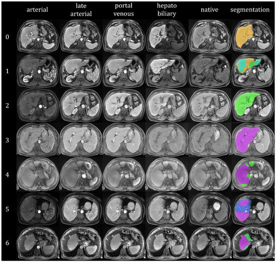 Application of A U-Net for Map-like Segmentation and Classification of Discontinuous Fibrosis ...