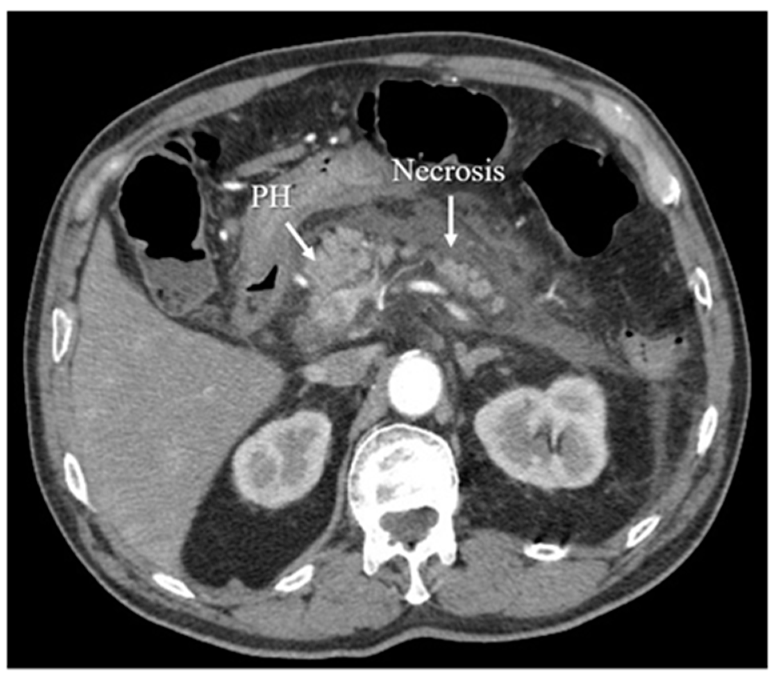 Hemorrhagic Pancreatitis Ultrasound