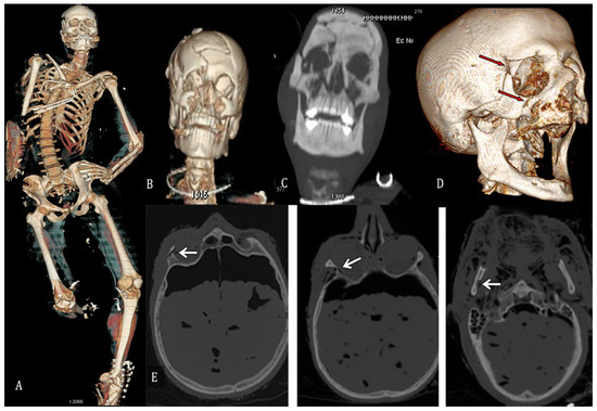 Diagnostics | Free Full-Text | Cause of Death in Charred Bodies ...