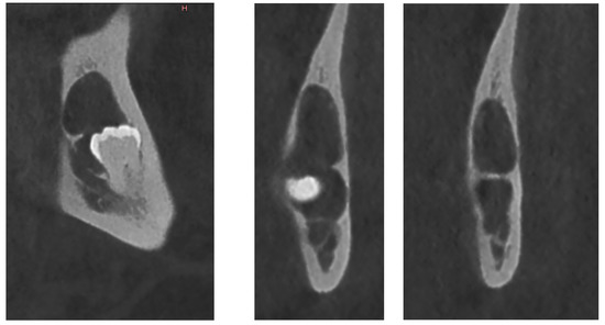 Dentigerous Cysts with Diverse Radiological Presentation Highlighting ...