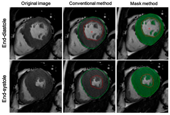 Papillary and Trabecular Muscles Have Substantial Impact on ...