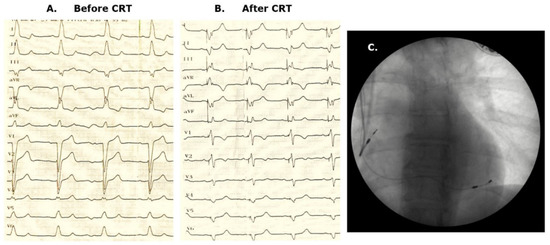 Diagnostics | Free Full-Text | Nonischemic Super-Responders in Fusion ...