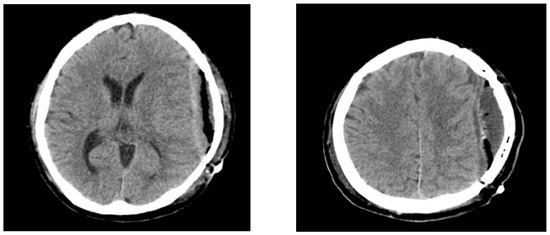 A Rare Case of Aphasia Caused by Delayed Epidural Abscess 6 Years after ...
