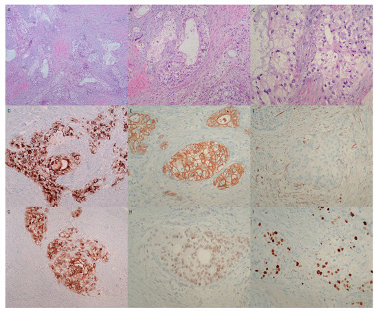 Primary Clear Cell Carcinoma of the Pancreas: A Rare Case Report