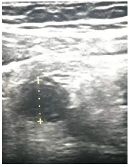 Point-of-Care Abdominal Ultrasonography (POCUS) on the Way to the Right ...