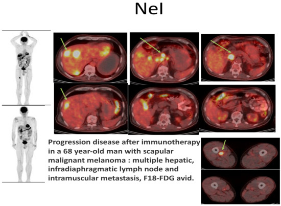 Diagnostics | Free Full-Text | Intra-Abdominal Malignant Melanoma ...