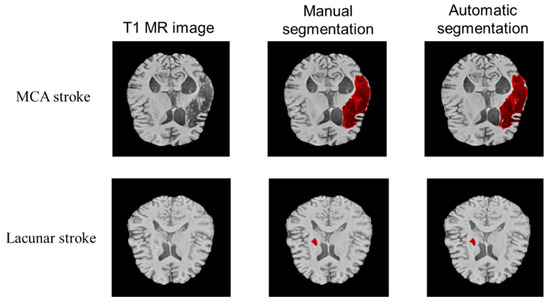 Automatic Segmentation and Quantitative Assessment of Stroke Lesions on ...
