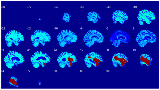 Automatic Segmentation and Quantitative Assessment of Stroke Lesions on MR Images