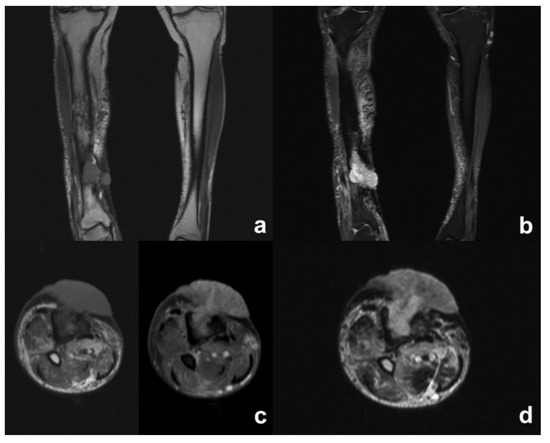 Management of Squamous Cell Carcinoma in Chronic Osteomyelitis: Our Experience, Review of the ...