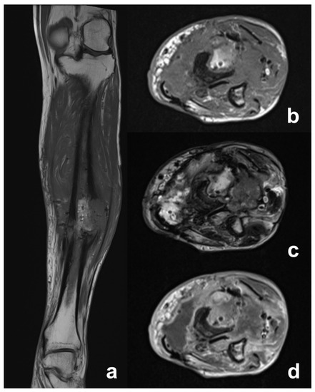 Management of Squamous Cell Carcinoma in Chronic Osteomyelitis: Our ...