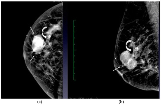 Encapsulated Papillary Carcinoma: A Rare Case Report and Its Imaging ...