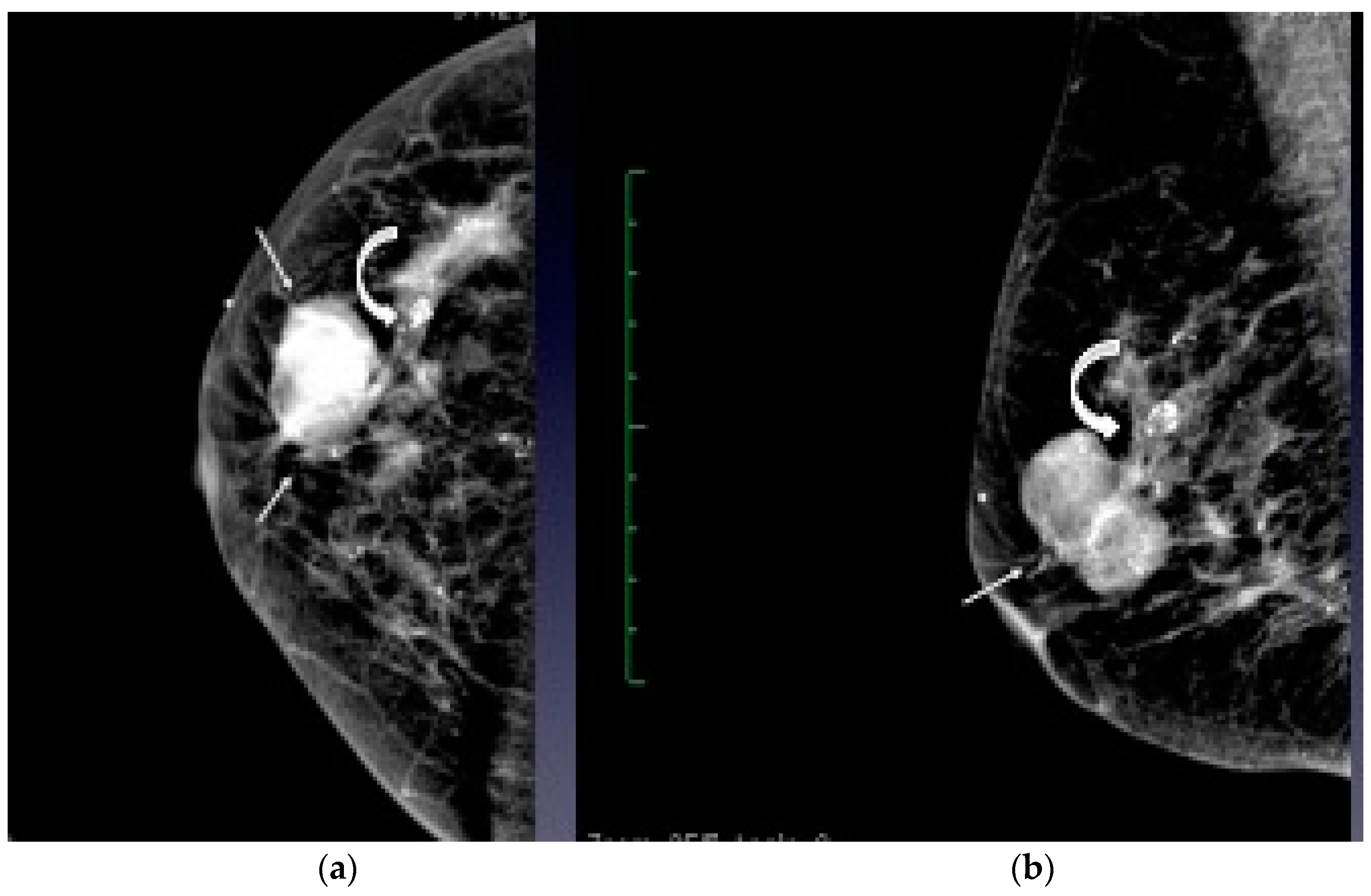 Encapsulated Papillary Carcinoma: A Rare Case Report and Its Imaging ...
