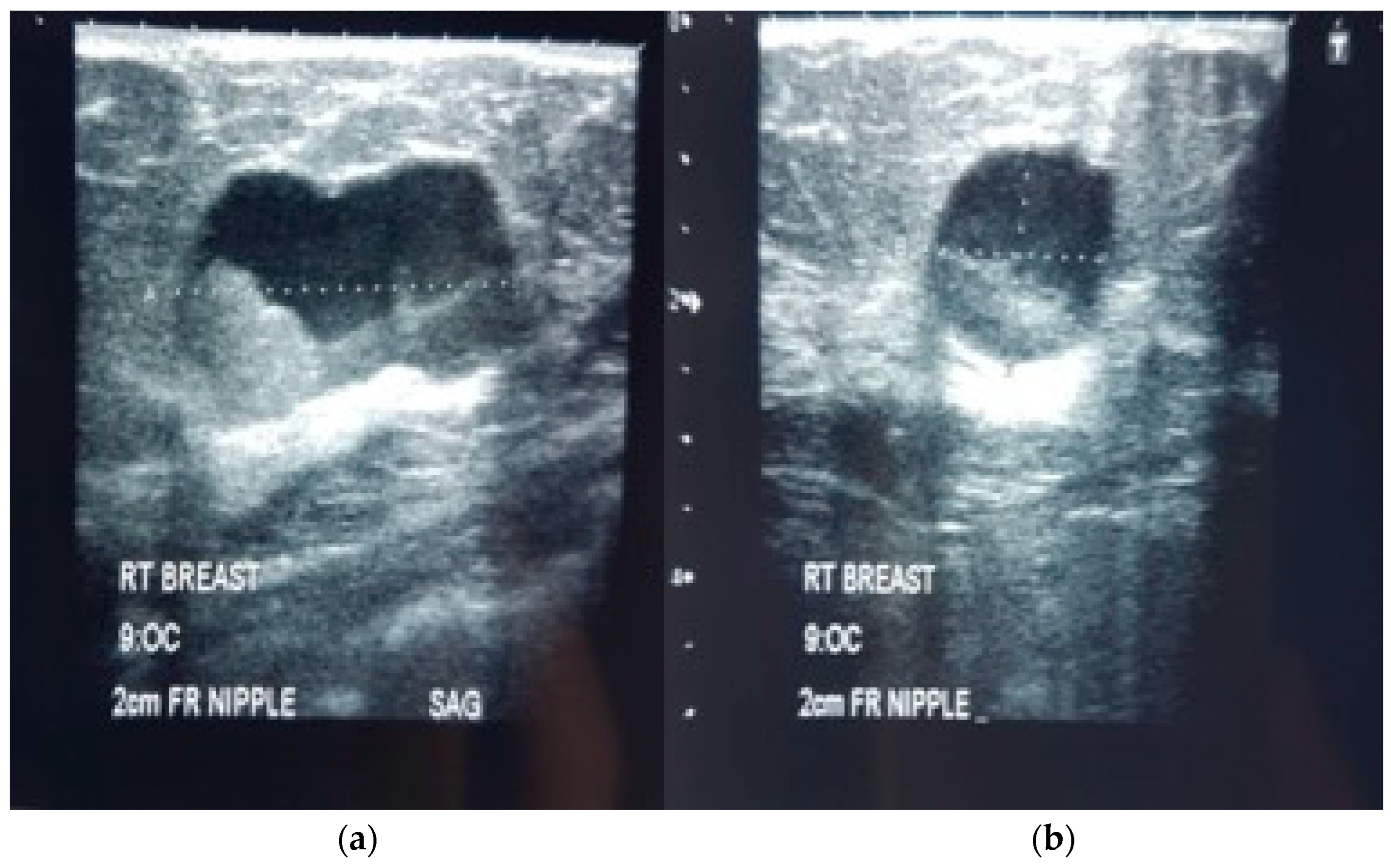 Encapsulated Papillary Carcinoma: A Rare Case Report and Its Imaging ...