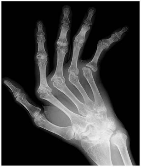Radiographic Findings of Inflammatory Arthritis and Mimics in the Hands