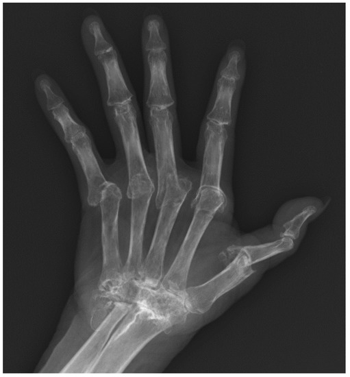 Radiographic Findings of Inflammatory Arthritis and Mimics in the Hands