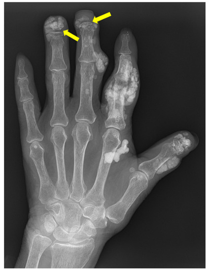 Radiographic Findings of Inflammatory Arthritis and Mimics in the Hands