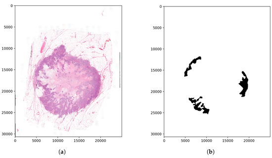 Breast Tumor Tissue Segmentation with Area-Based Annotation Using ...