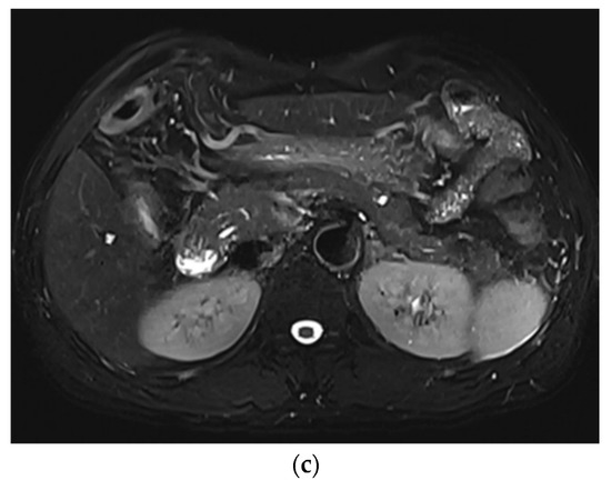Diagnostics | Free Full-Text | Improved Single Breath-Hold SSFSE Sequence for Liver MRI Based on ...