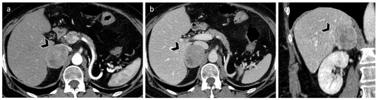 Adrenal Lesions: A Review of Imaging
