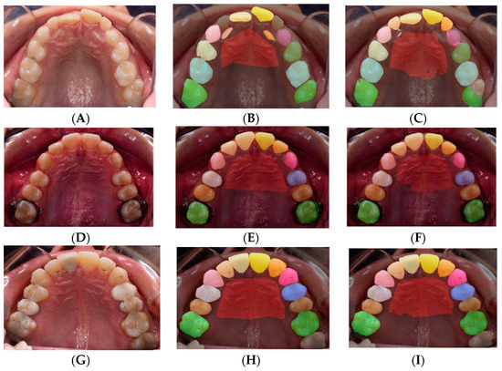 Semantic Segmentation of Maxillary Teeth and Palatal Rugae in Two ...