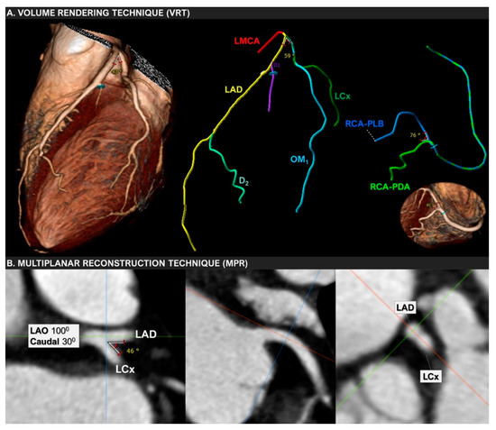 Relationship between Coronary Arterial Geometry and the Presence and ...