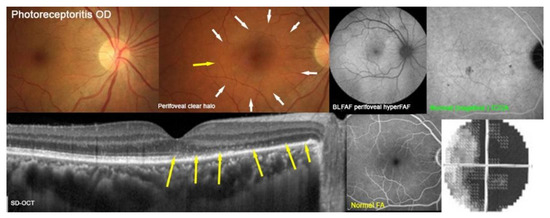 Diagnosis, Mechanisms, and Differentiation of Inflammatory Diseases of ...