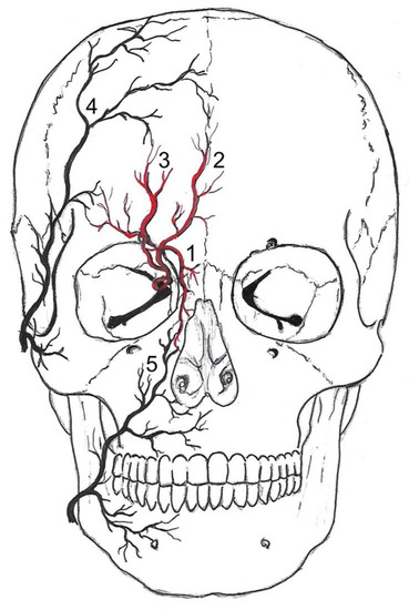 The Supratrochlear Artery Sign—A New Piece in the Puzzle of Cerebral ...