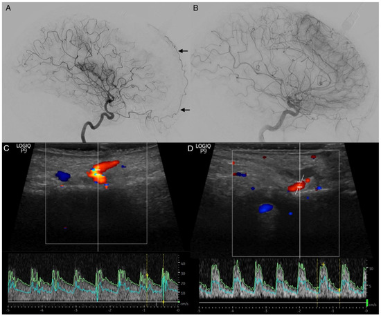 The Supratrochlear Artery Sign—A New Piece in the Puzzle of Cerebral ...