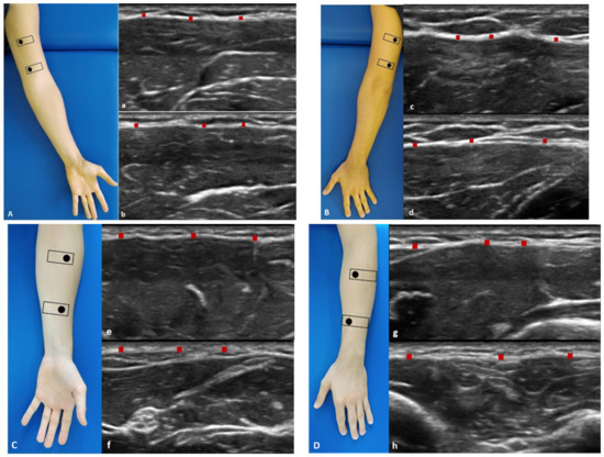 Inter- and Intra-Rater Reliability of Ultrasound Measurements of ...
