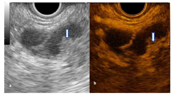 Clinical Utility of the Contrast-Enhanced Endoscopic Ultrasound Guided ...