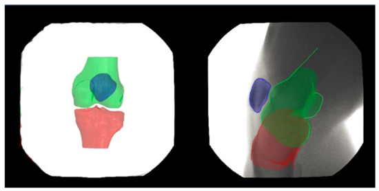 Automatic Bone Segmentation from MRI for Real-Time Knee Tracking in ...