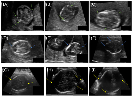 Ensemble Transfer Learning for Fetal Head Analysis: From Segmentation to Gestational Age and ...