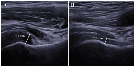 Diagnostics | Free Full-Text | Sequential Ultrasound Assessment of Peri ...