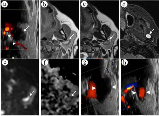 Vascular Abnormalities of the Parotid Region: An Uncommon Presentation ...