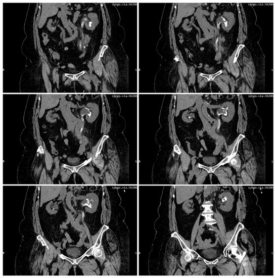 Encrusted Uretero-Pyelitis Caused by Corynebacterium urealyticum: Case ...