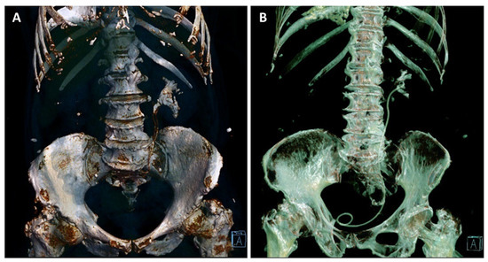 Encrusted Uretero-Pyelitis Caused by Corynebacterium urealyticum: Case ...