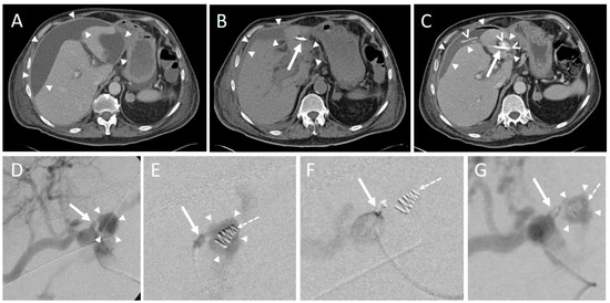 Low-Milliampere CT Fluoroscopy-Guided Percutaneous Drainage Placement ...