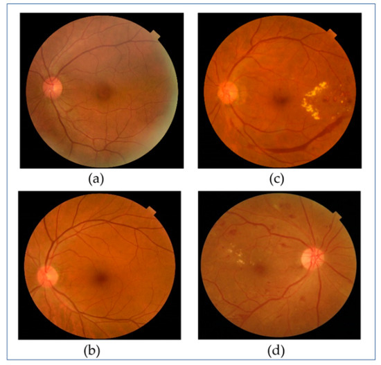 Automatic Screening of Diabetic Retinopathy Using Fundus Images and ...