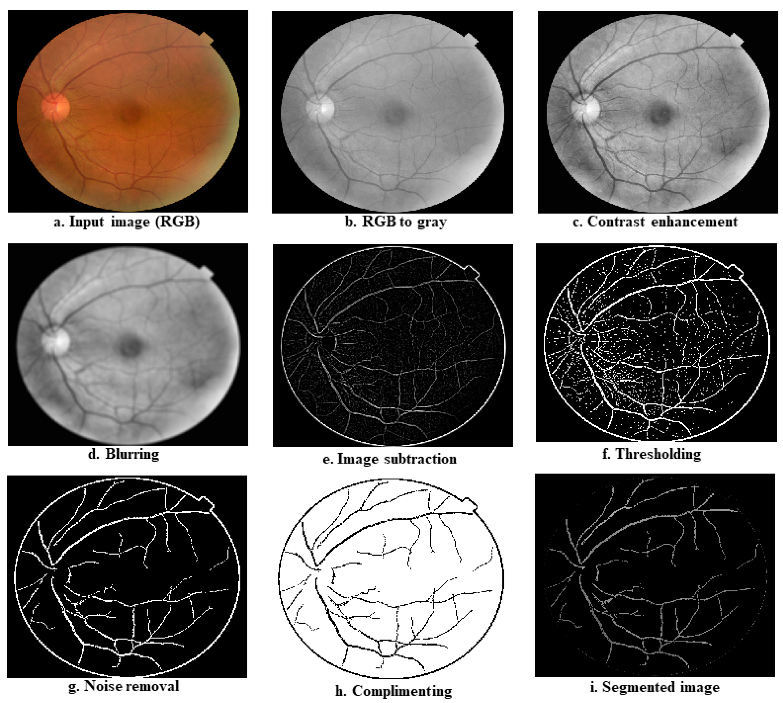 Automatic Screening of Diabetic Retinopathy Using Fundus Images and ... Automatic Screening of Diabetic Retinopathy Using Fundus Images and ...