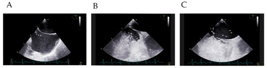 Pitfalls of Using Imaging Technique in the Presence of Eustachian Valve ...