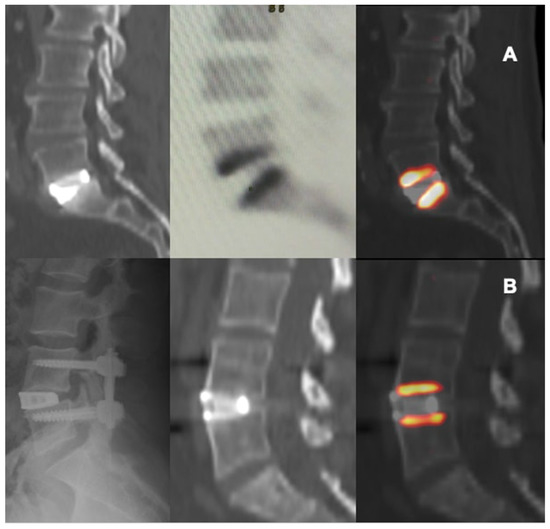 Diagnostics | Free Full-Text | The Efficacy of Trabecular Titanium ...
