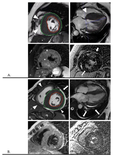 Heart Failure and Cardiomyopathies: CT and MR from Basics to Advanced ...