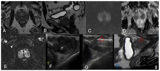 Granulomatous Prostatitis, the Great Mimicker of Prostate Cancer: Can ...