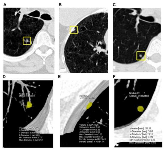 Intra And Inter Reader Variations In Lung Nodule Measurements Influences Of Nodule Size