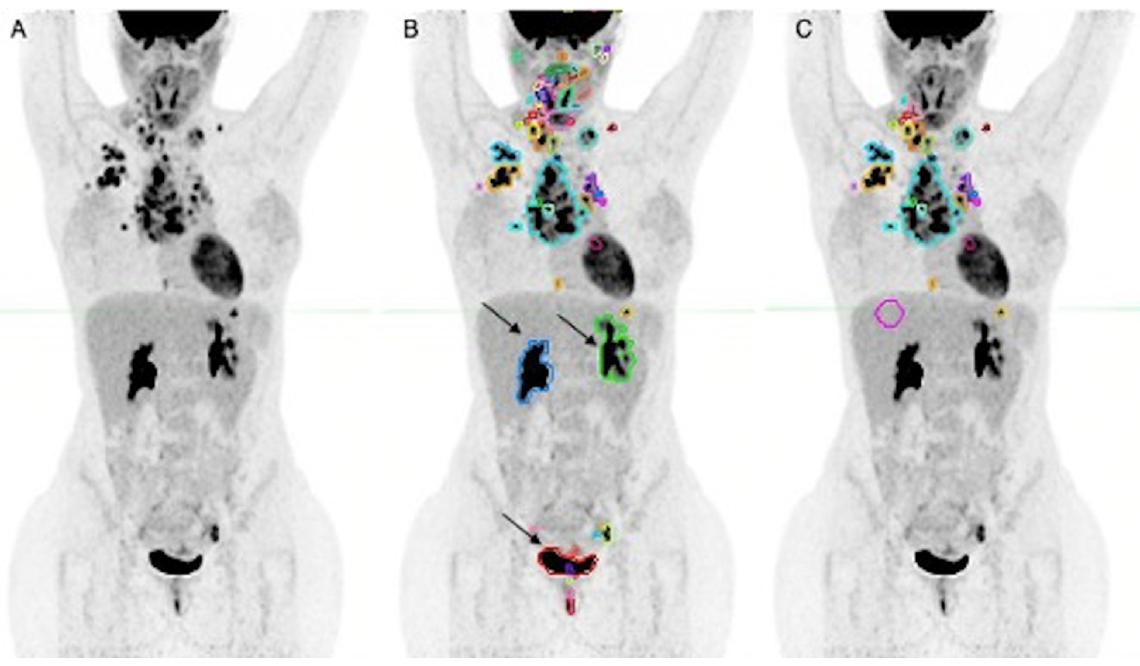 Diagnostics | Free Full-Text | Classical Hodgkin Lymphoma: A Joint Clinical and PET Model to ...