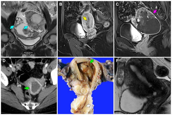 Endometrioid Carcinomas of the Ovaries and Endometrium Involving ...