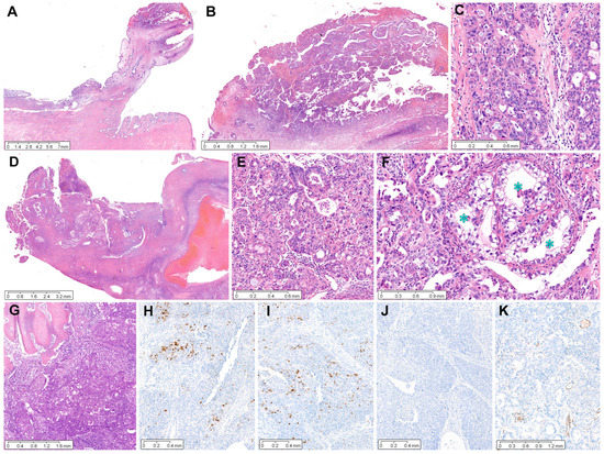 Endometrioid Carcinomas of the Ovaries and Endometrium Involving ...