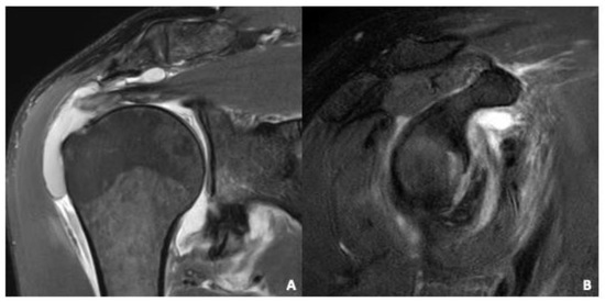 Assessment of Acute Lesions of the Biceps Pulley in Patients with ...
