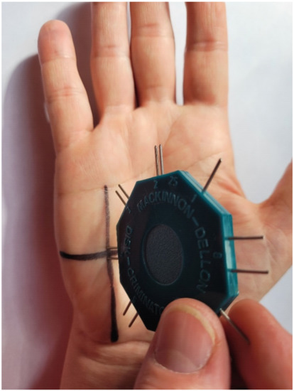 Reliability of Ulnar Nerve Sensation Tests in Patients with Cubital ...