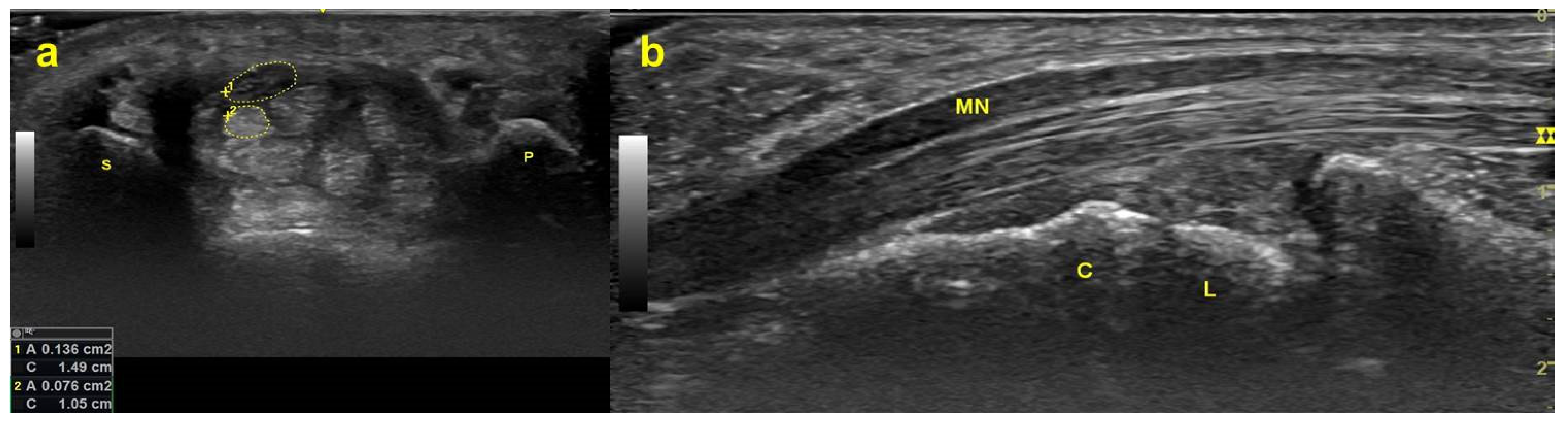 Decreased Median Nerve Distribution